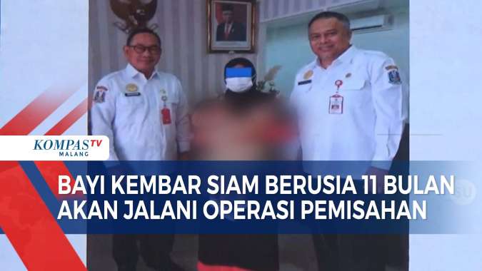 Pertama Kali di Malang, RSSA Akan Operasi Pemisahan Bayi Kembar Siam