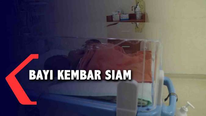 Bayi Kembar Siam Asal Kisaran Dirawat di RSUP Haji Adam Malik Medan