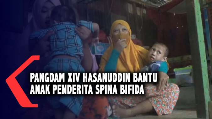 Pangdam XIV Hasanuddin Bantu Anak Penderita Spina Bifida Pangdam XIV Hasanuddin Bantu Anak Penderita Spina Bifida