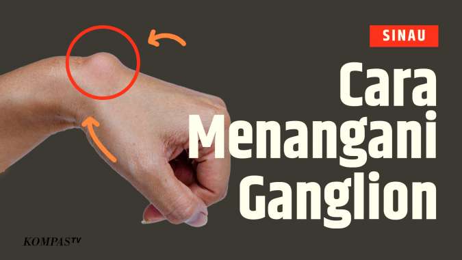 Apa itu Ganglion dan Bagaimana Cara Menanganinya?| SINAU