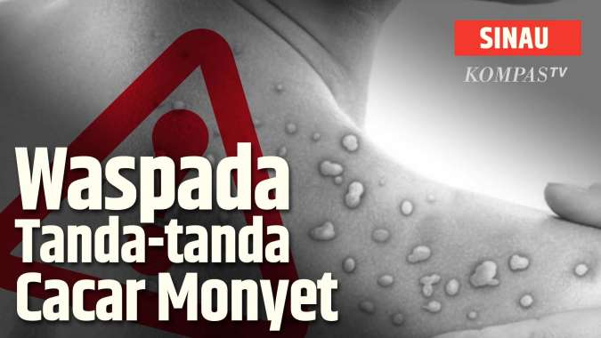 Awas Penyakit Cacar Monyet, Ini lo Gejalanya | SINAU