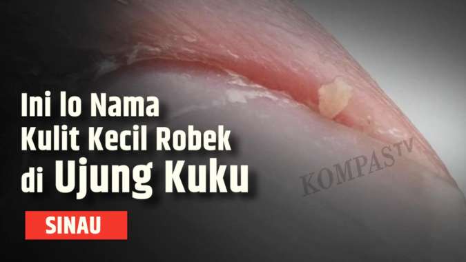 Rupanya Ini Nama Kulit yang Robek di Ujung Kuku, kalau Dicabut Begini ...